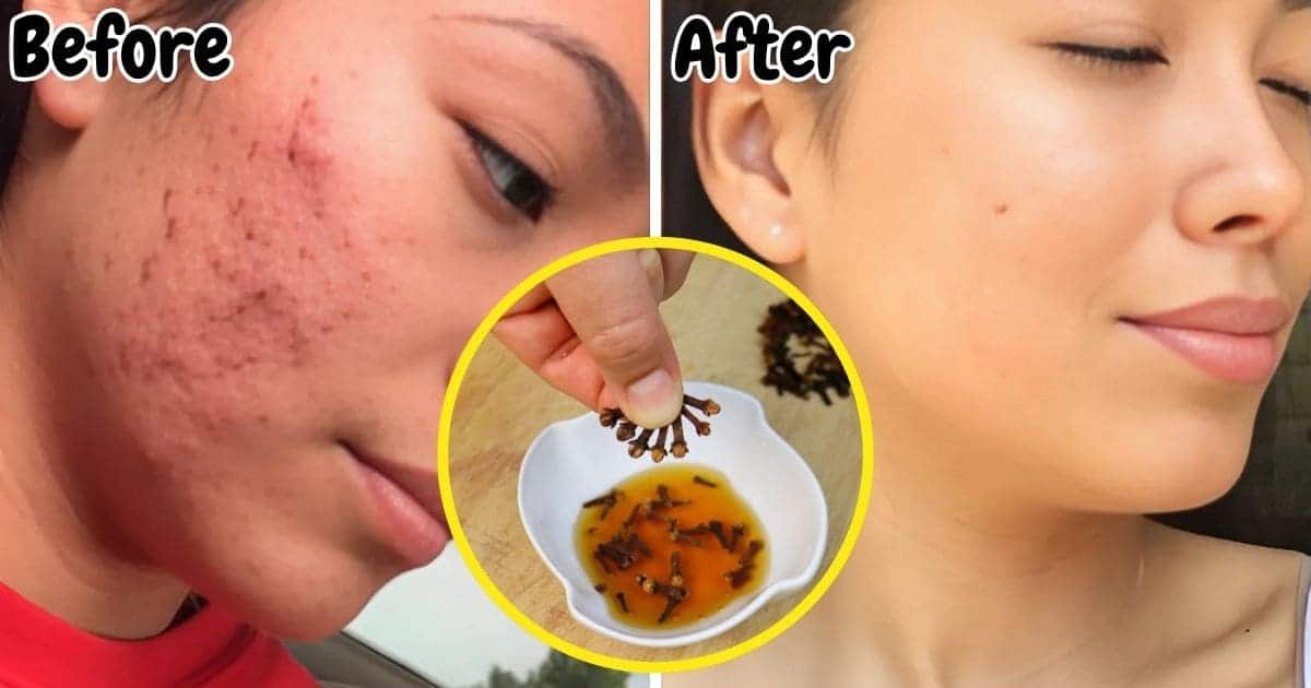 7 Incredible Health Benefits of Clove Tea That Will Transform Your ...